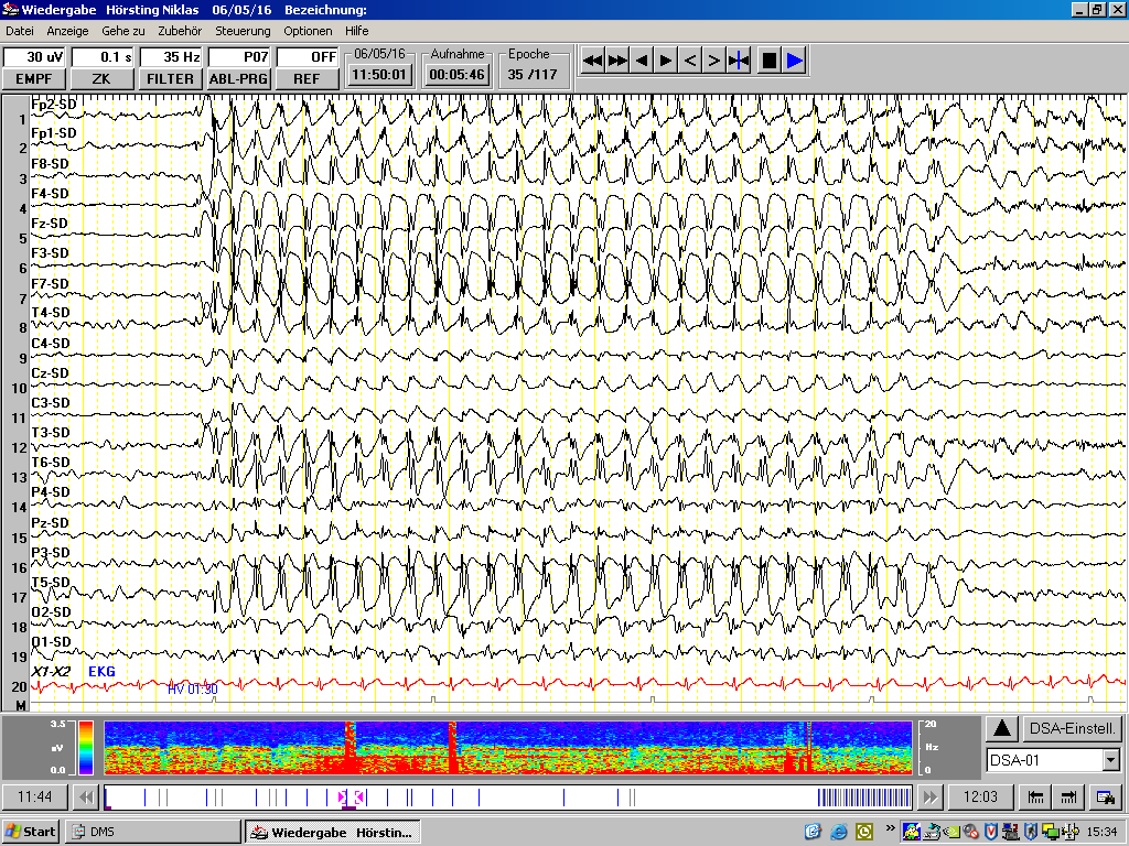 Diagnostik von Epilepsien - arztCME